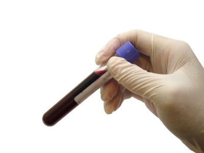 Taking Blood Samples From Short Peripheral IV Catheters