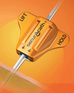 SecurAcath receives NICE recommendation: Highlights massive cost ...